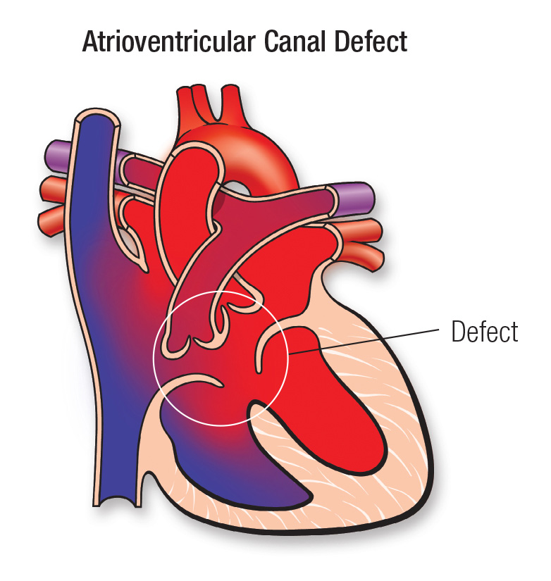 Defecto del canal auriculoventricular completo (CAVC) | Go Red for Women