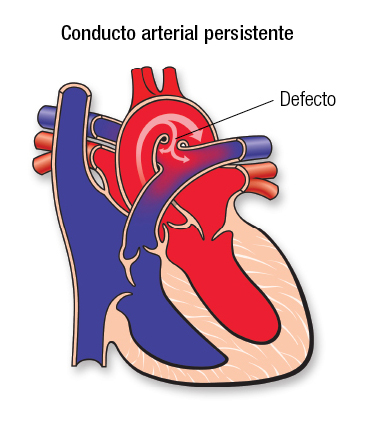 Persistencia del ductus arterioso (PDA) | Go Red for Women