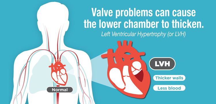 ¿Qué es la hipertrofia ventricular izquierda (HVI)? | Go Red for Women