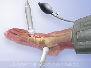 How is PAD Diagnosed? | Go Red for Women