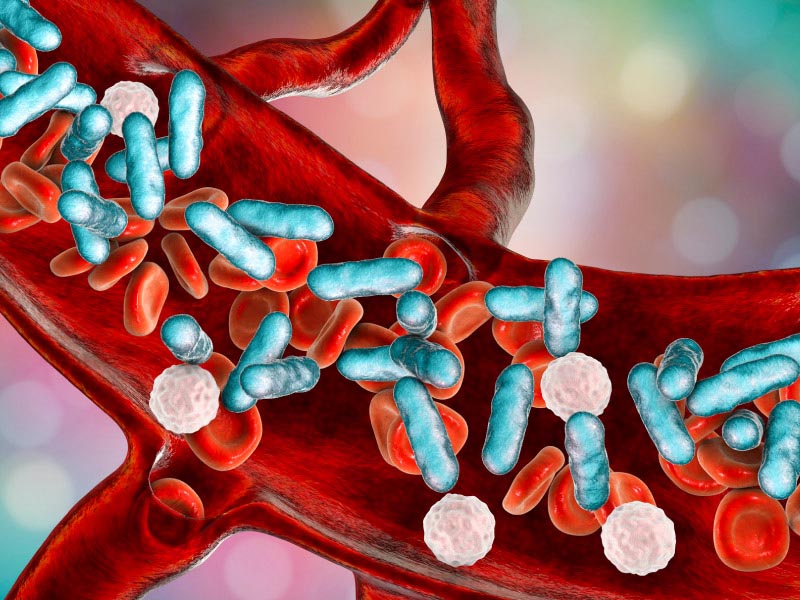 Never heard of sepsis? It's common, dangerous and a threat to your ...