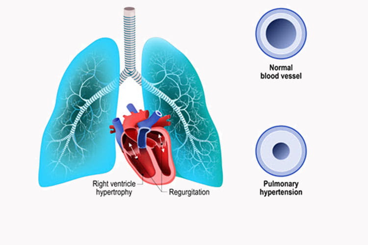 Evaluation and Management of Pulmonary Hypertension in Non-Cardiac Surgery - Professional Heart ...
