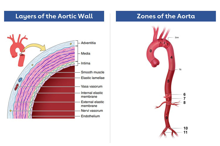 2022 ACC/AHA Guideline for the Diagnosis and Management of Aortic ...